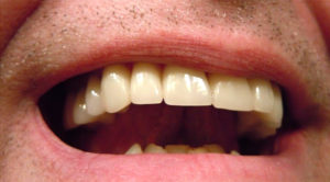 How Eating Disorders Affect Your Teeth - Space Coast Daily