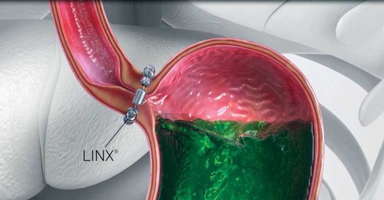 For Reflux Disease Health First is Leading with LINX, Listen to Dr ...