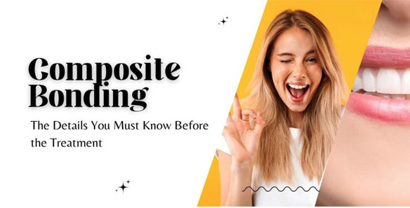 The Complete Guide to Composite Bonding - Space Coast Daily