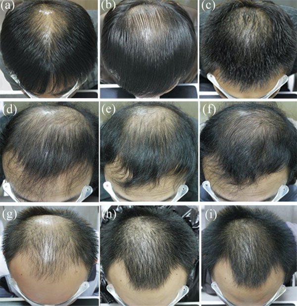 Hair Regrowth – Understanding How to Restore Your Hair - Space Coast Daily