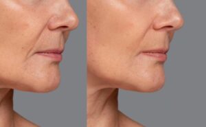 Profhilo Before and After Jowls: Transform Your Jawline - Space Coast Daily